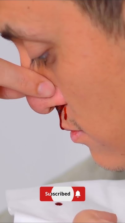 Nose bleed | Epistaxis | Epistaxis treatment - YouTube