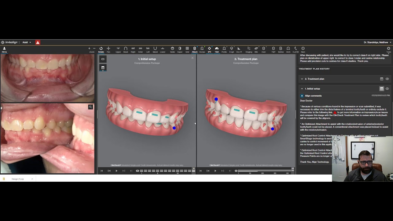 Invisalign or Aligner Distalization Mechanics Case Example 1 - YouTube