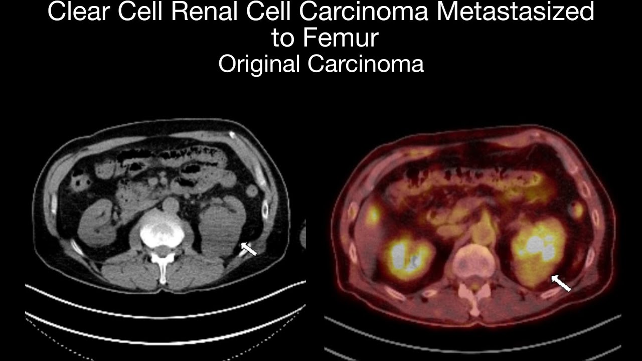 Renal Cell Carcinoma Case 24: Clear-Cell Renal Cell Carcinoma ...