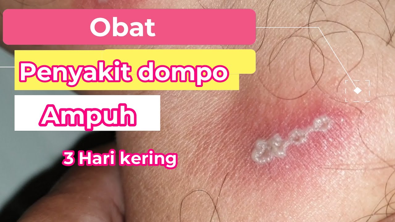 Obat penyakit dompo atau dampa paling ampuh - YouTube
