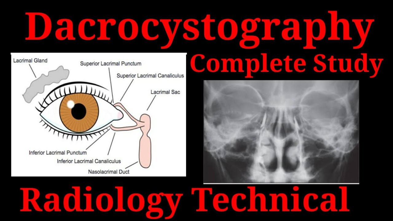 Dacryocystography procedure # complete study || Radiology technical ...
