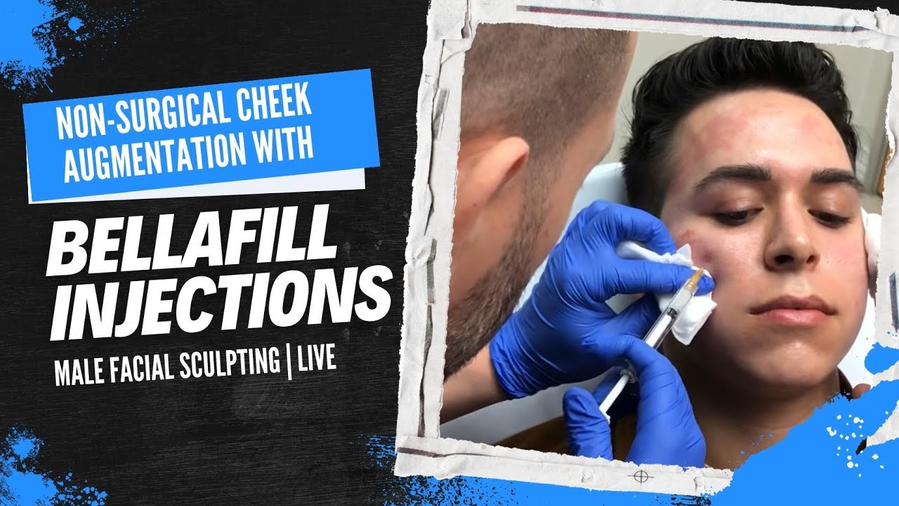 Non-Surgical Cheek Augmentation with Bellafill Injections | Male Facial ...