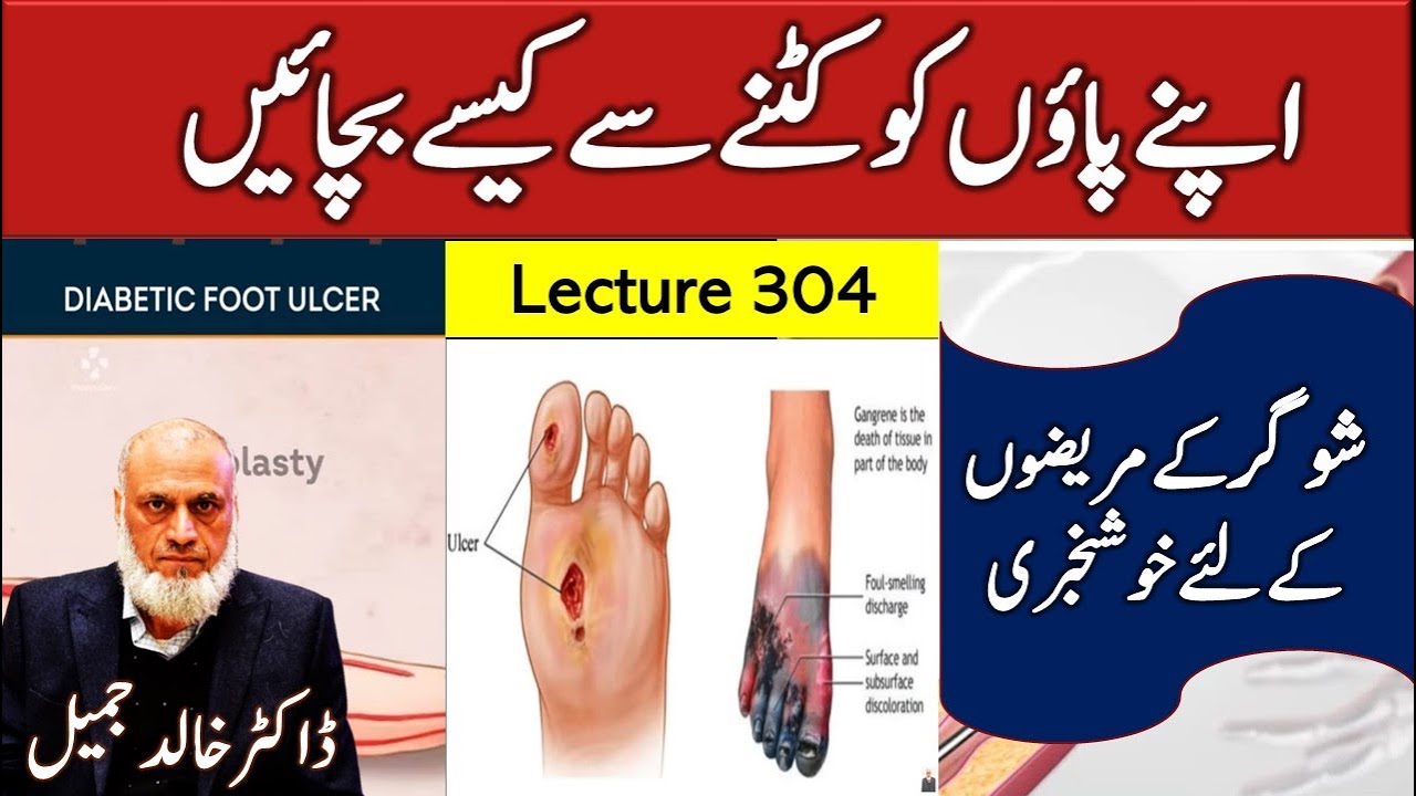 Foot care for poor circulation in Diabetic Patients | lecture 304 - YouTube