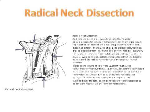 Radical Neck Dissection - YouTube