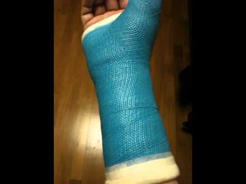 Short Arm Thumb Spica - YouTube