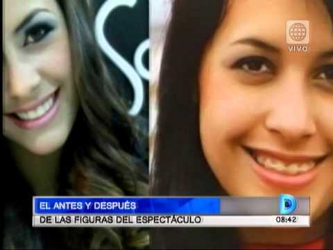 Antes y despues de Michael Soifer, Natalie Vertiz, Tilsa Lozano, Milett ...