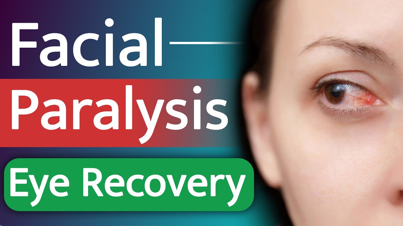 Facial Paralysis Eye Recovery | Eye Recovery After Bell's Palsy | Bell ...