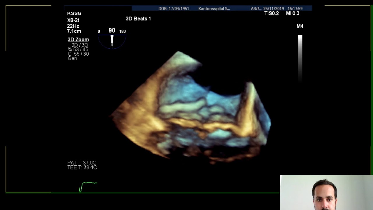 149_Rusch, Andreas: "Cord-like" mobile left atrial mass; KSSG - YouTube