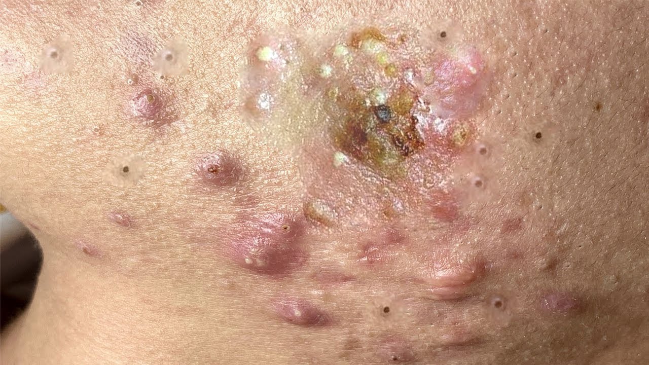 Big Cystic Acne Blackheads Extraction Blackheads & Milia, Whiteheads ...