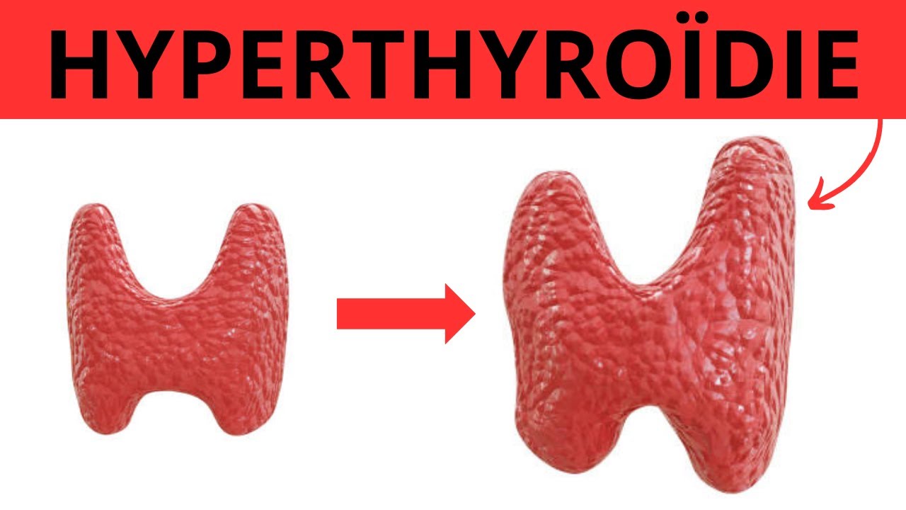 Hyperthyroïdie : Symptômes, Causes, Diagnostic, Traitement - YouTube