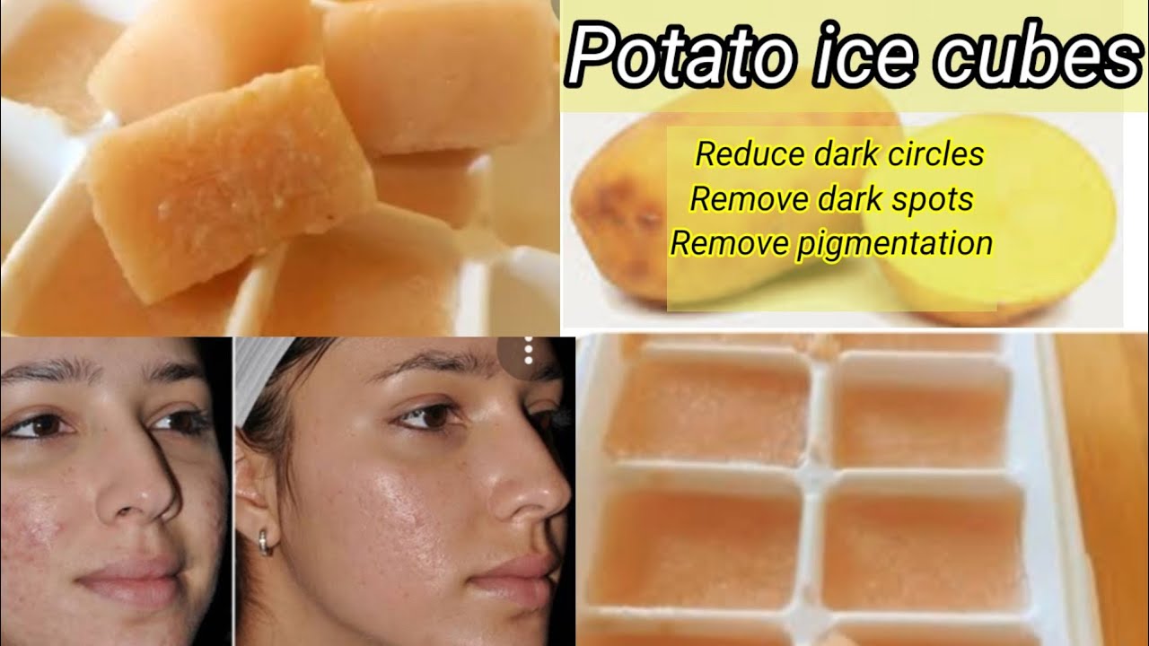 Potato ice cubes to treat acne scars, pigmentation,dark sports, pimple ...