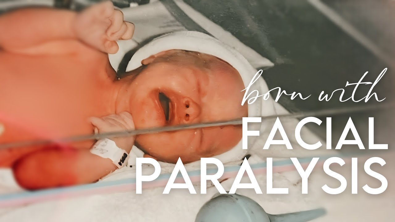 born with facial paralysis - YouTube
