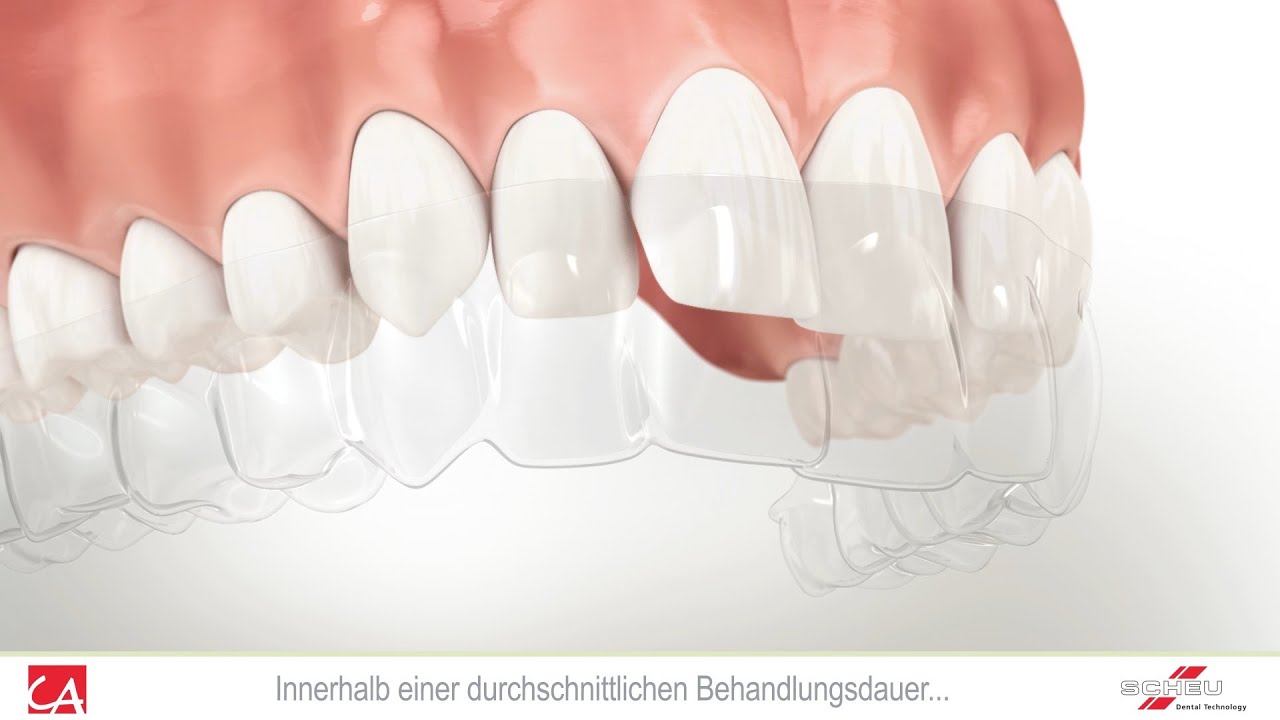 Korrektur von Zahnfehlstellung mit unsichtbarer Schiene - YouTube