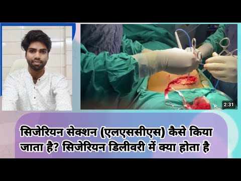 How is Cesarean Section ( LSCS) done? Cesarean delivery me kya hota hai ...