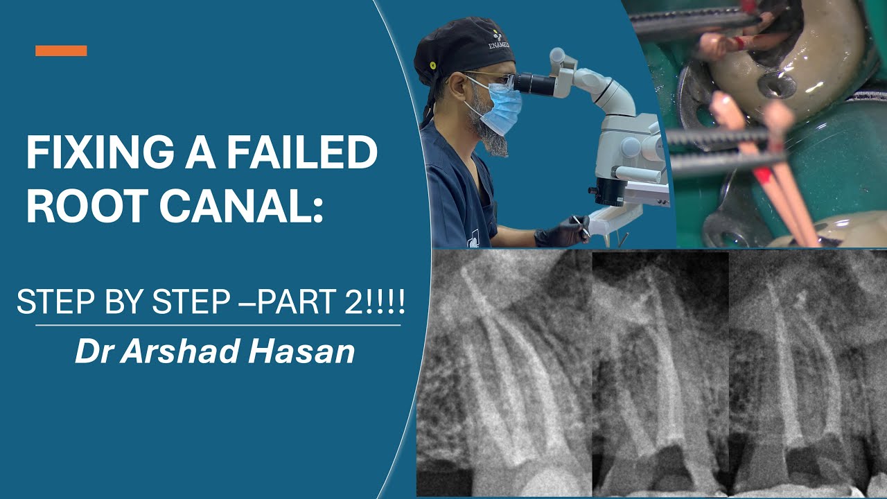 FIXING A FAILED ROOT CANAL: STEP-BY-STEP - PART 2!!!!! - YouTube