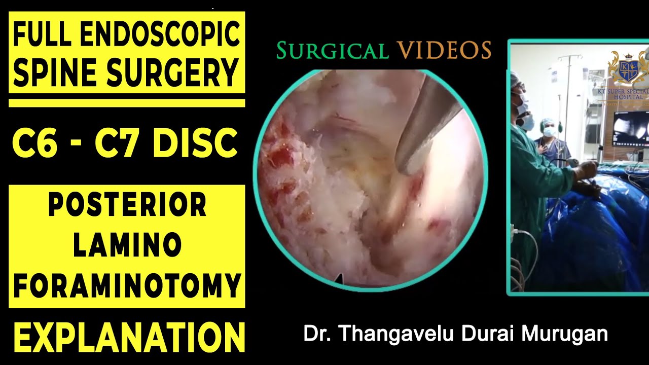 C6-C7 DISC | FULL ENDOSCOPIC SPINE SURGERY - YouTube