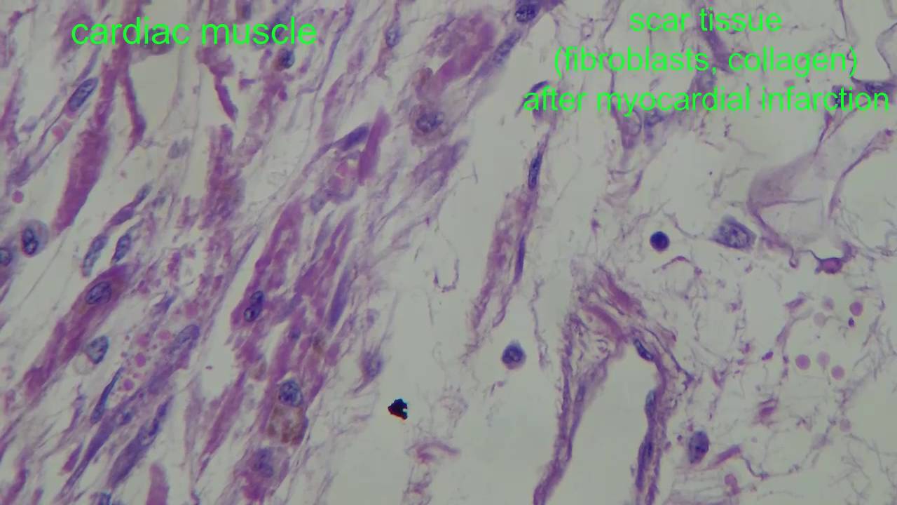 SCAR TISSUE AFTER MYOCARDIAL INFARCTION PART2 - YouTube