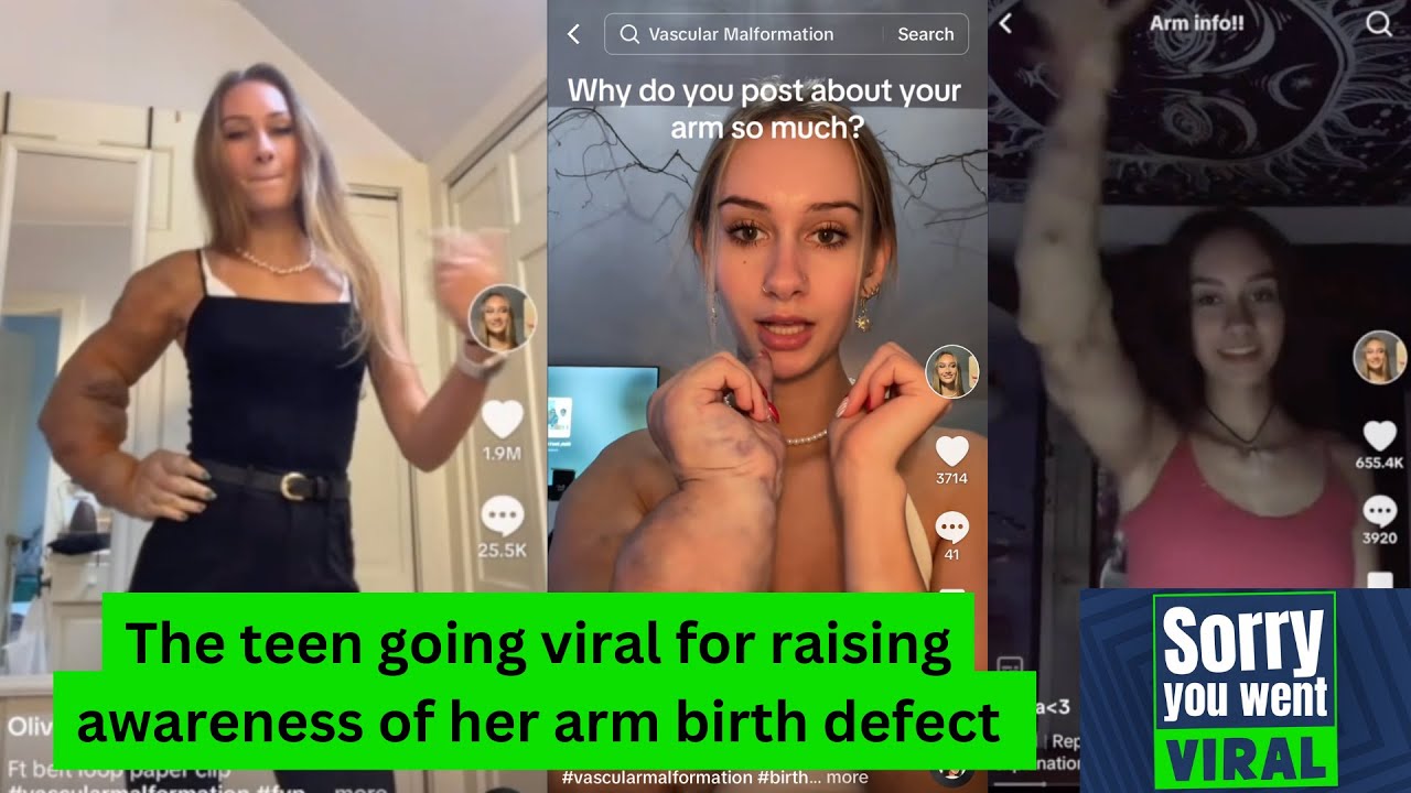 The teen going viral for raising awareness of vascular arm malformation ...