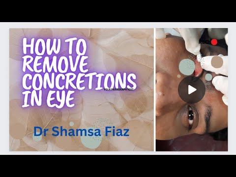 How to Remove Conjunctival Concretions in Simple way - YouTube