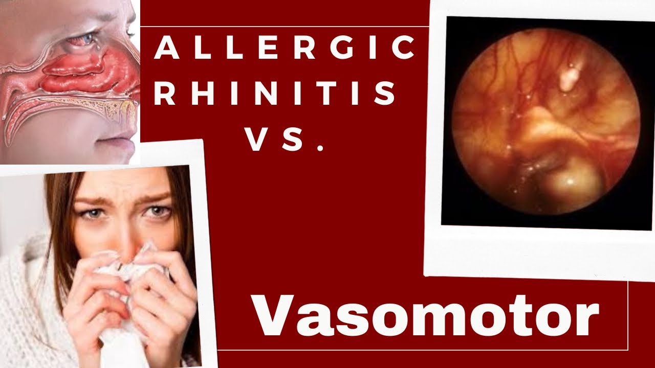Allergic rhinitis and Vasomotor rhinitis | Difference | ENT nose - YouTube