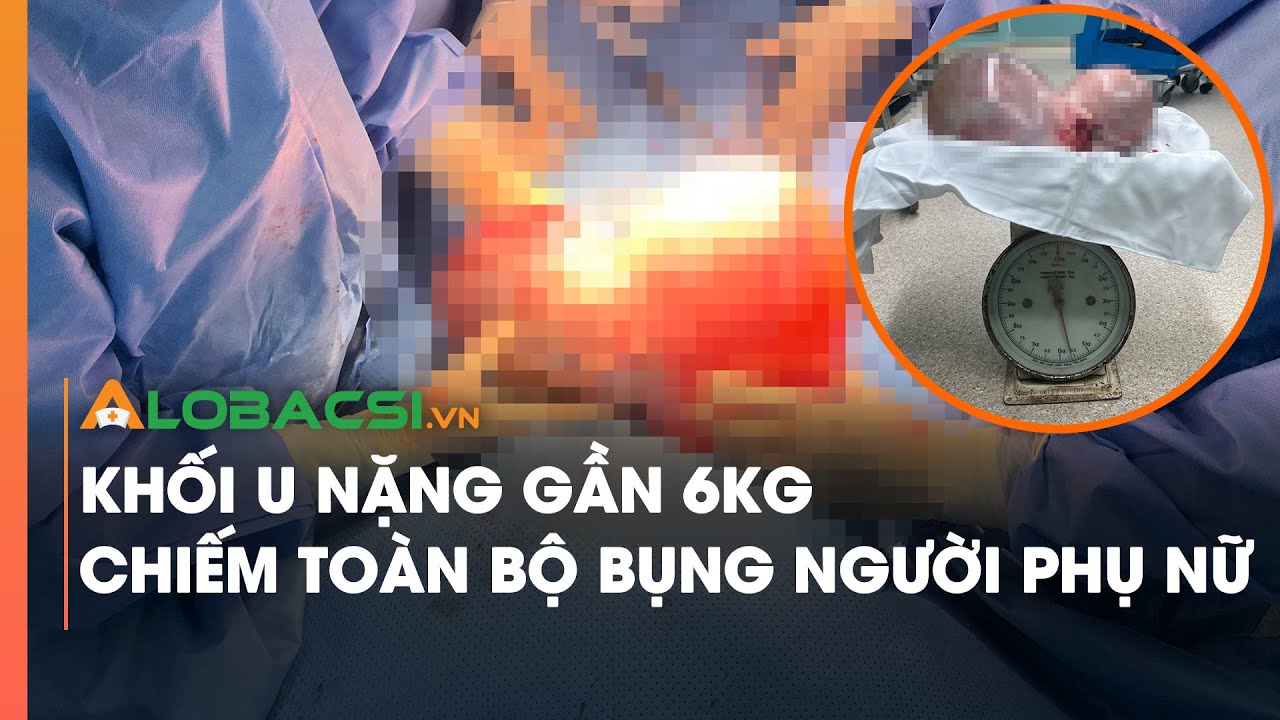 Khối u nặng gần 6kg chiếm toàn bộ bụng người phụ nữ - YouTube