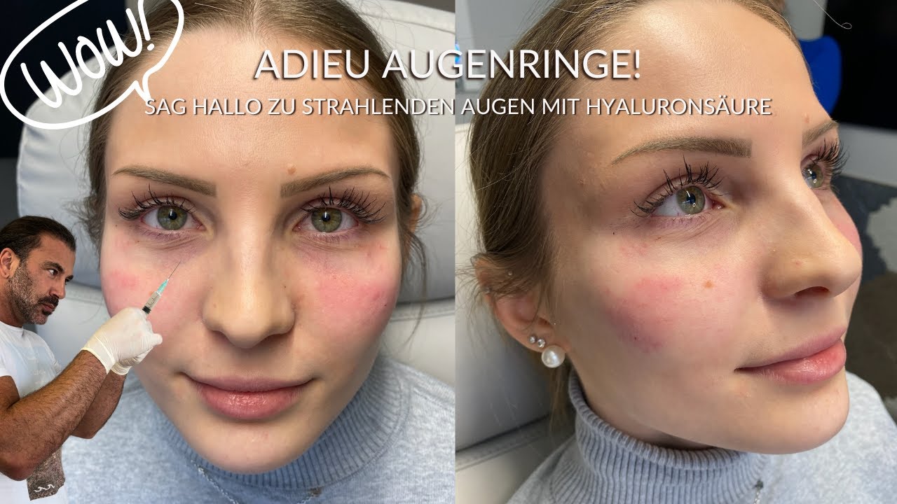 Augenringe Behandlung mit Hyaluronsaure - YouTube