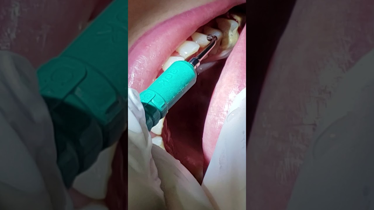 Deep Dental Cleaning of teeth supra and subgingival - YouTube
