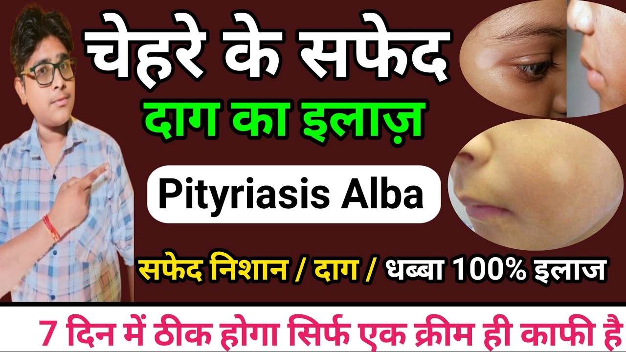 चेहरे के सफेद दाग इलाज़| Face par white daag kaise hataye | Pityriasis ...