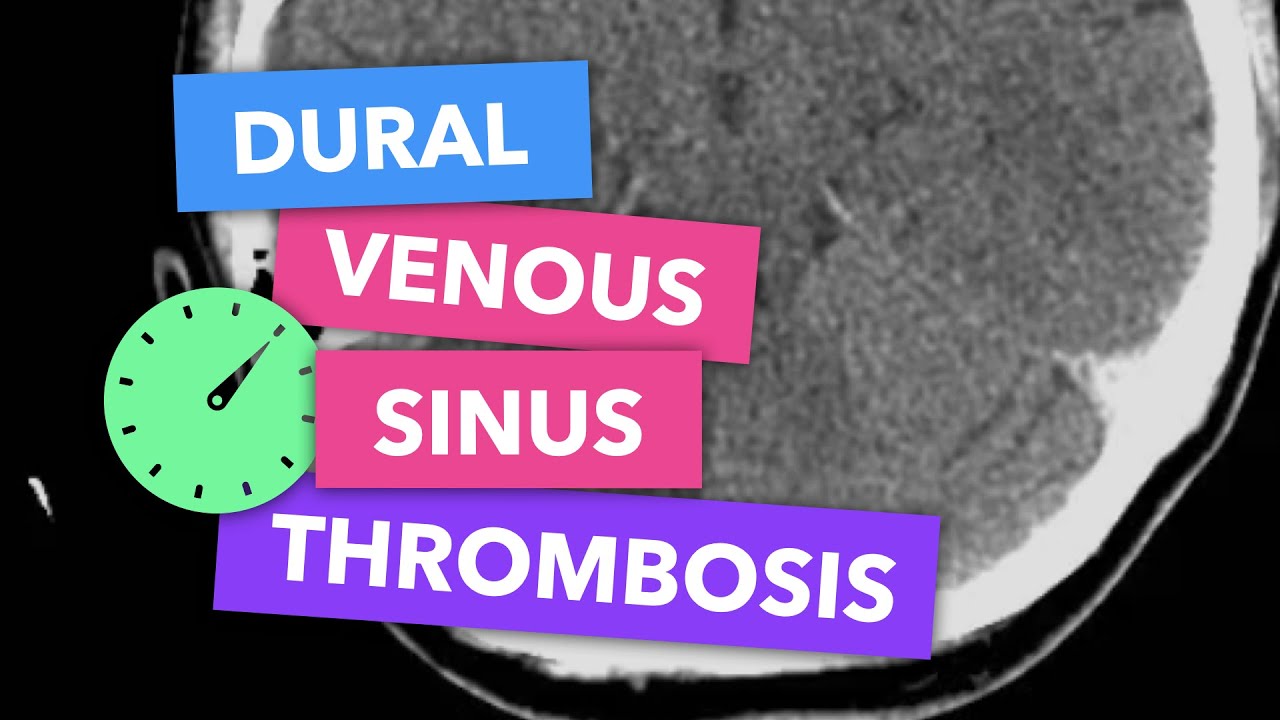 Dural Venous Sinus Thrombosis Symptoms Causes Treatme