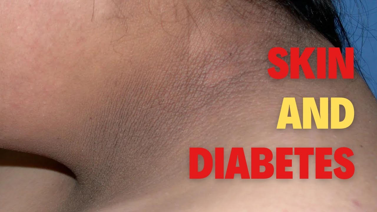 Know if you have diabetes by recognizing these signs on your skin - YouTube