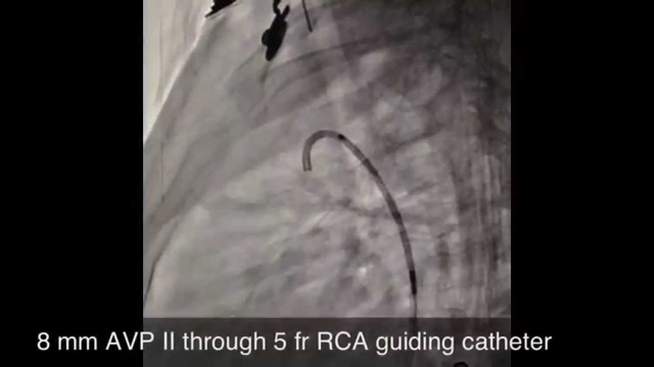 DrRaviRT - Tortuous PDA Device Closure using AVP II. - YouTube