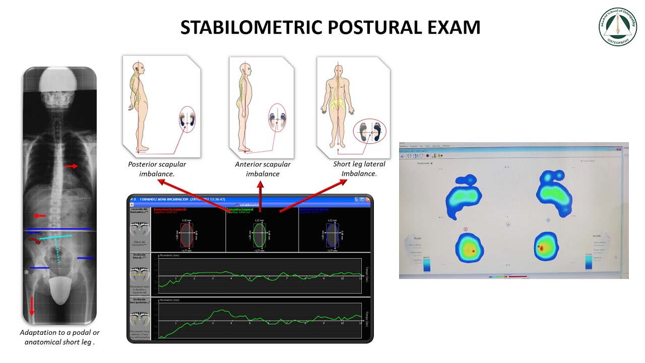 POSTURAL OSTEOPATHIC EXAMINATION IN LUMBAR DISC PROLAPSE - YouTube