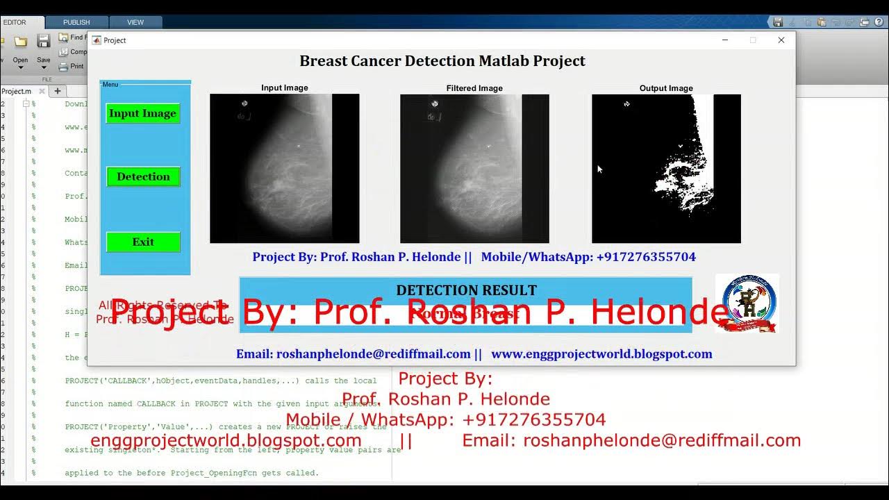 Breast Cancer Detection Using Matlab Breast Cancer Prediction Using