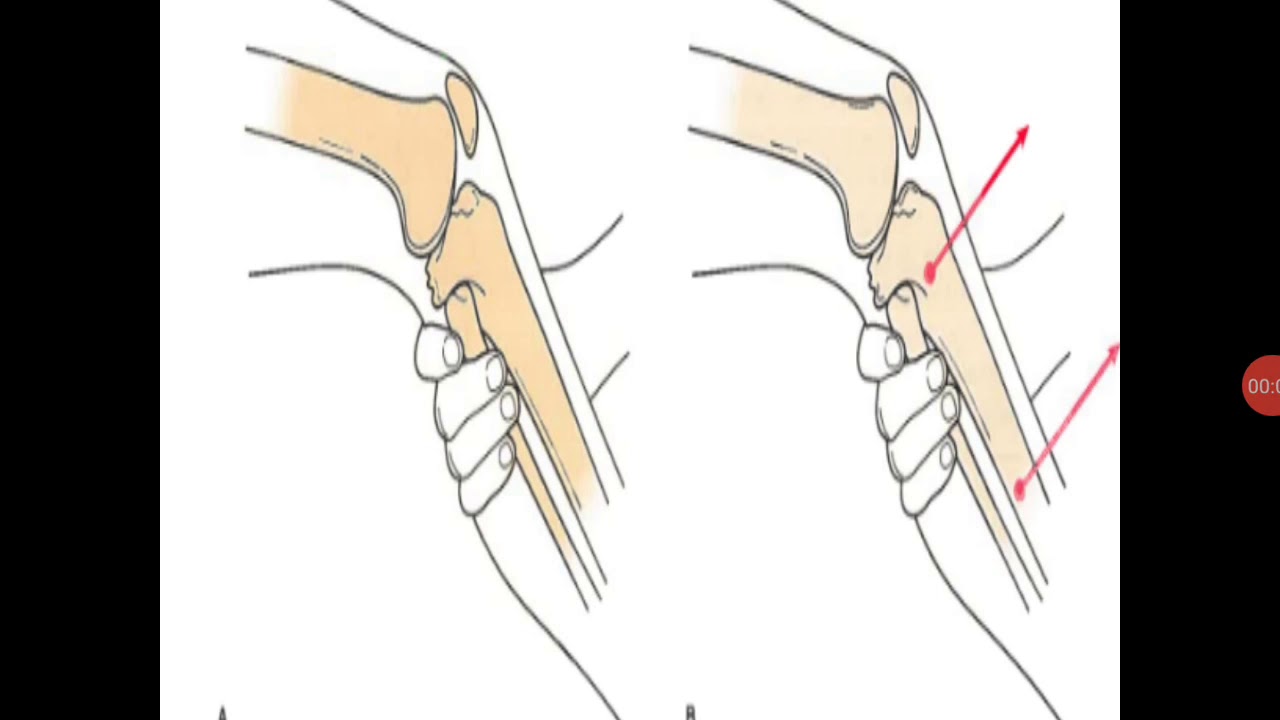 Linear displacement/ translatory motion example/ ACL test - YouTube