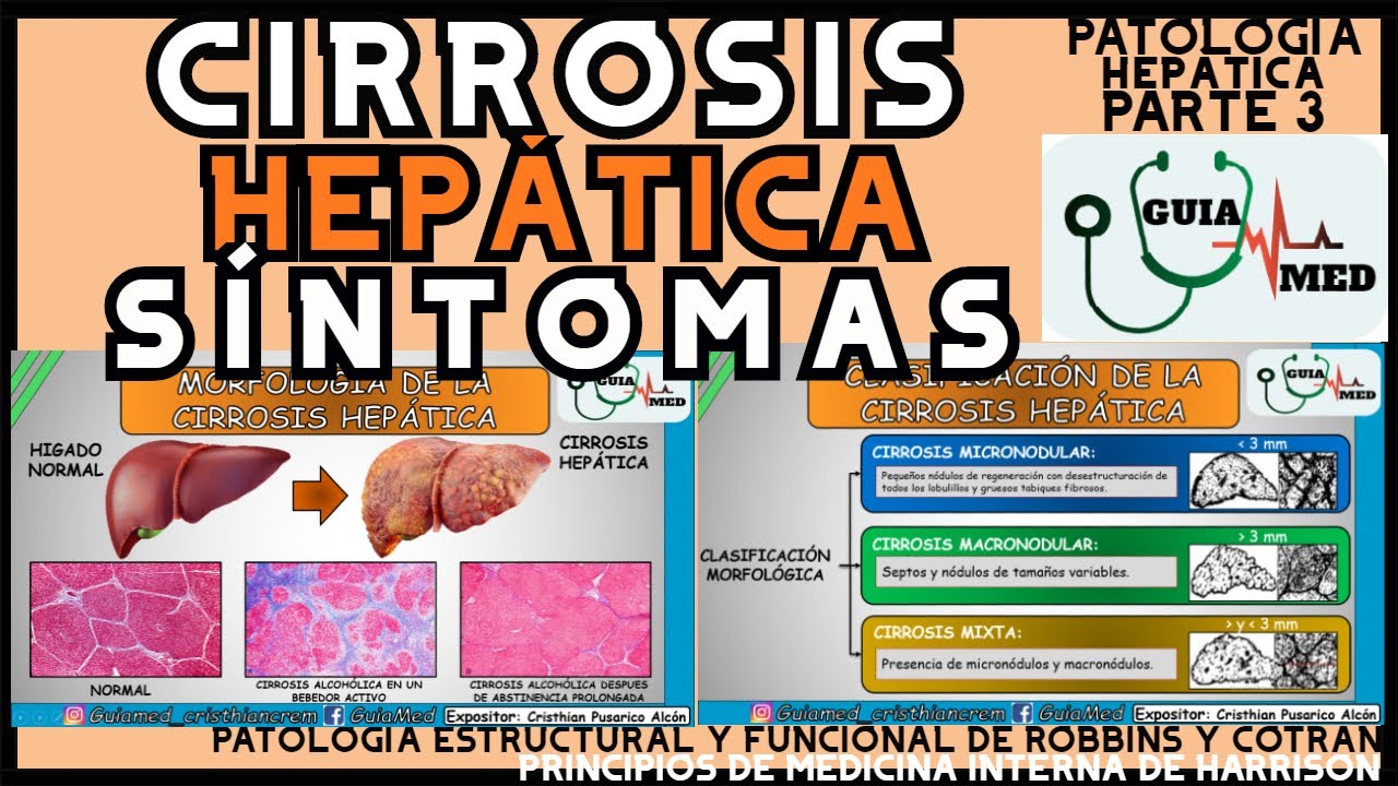 Cirrosis Hepatica Sintomas