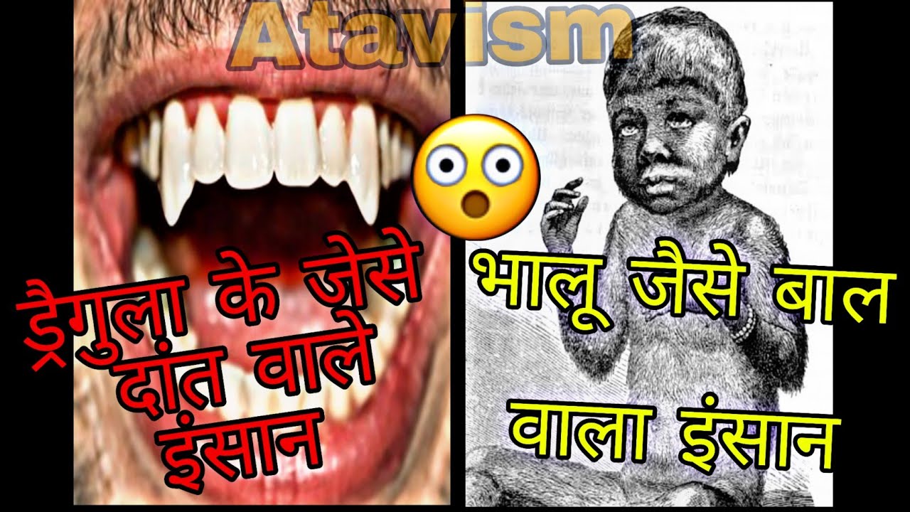 Atavism | Tail in Human beings | Dragula like Teeth in Humans ...