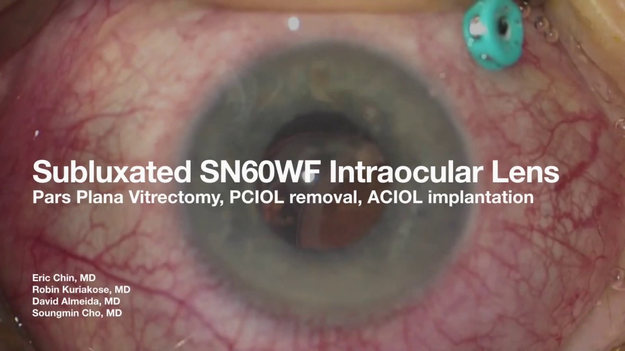 Subluxated SN60WF Intraocular Lens - YouTube