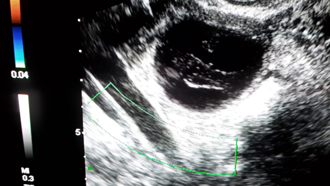 Ultrasound Diagnosis of Complex Ovarian Cyst - YouTube