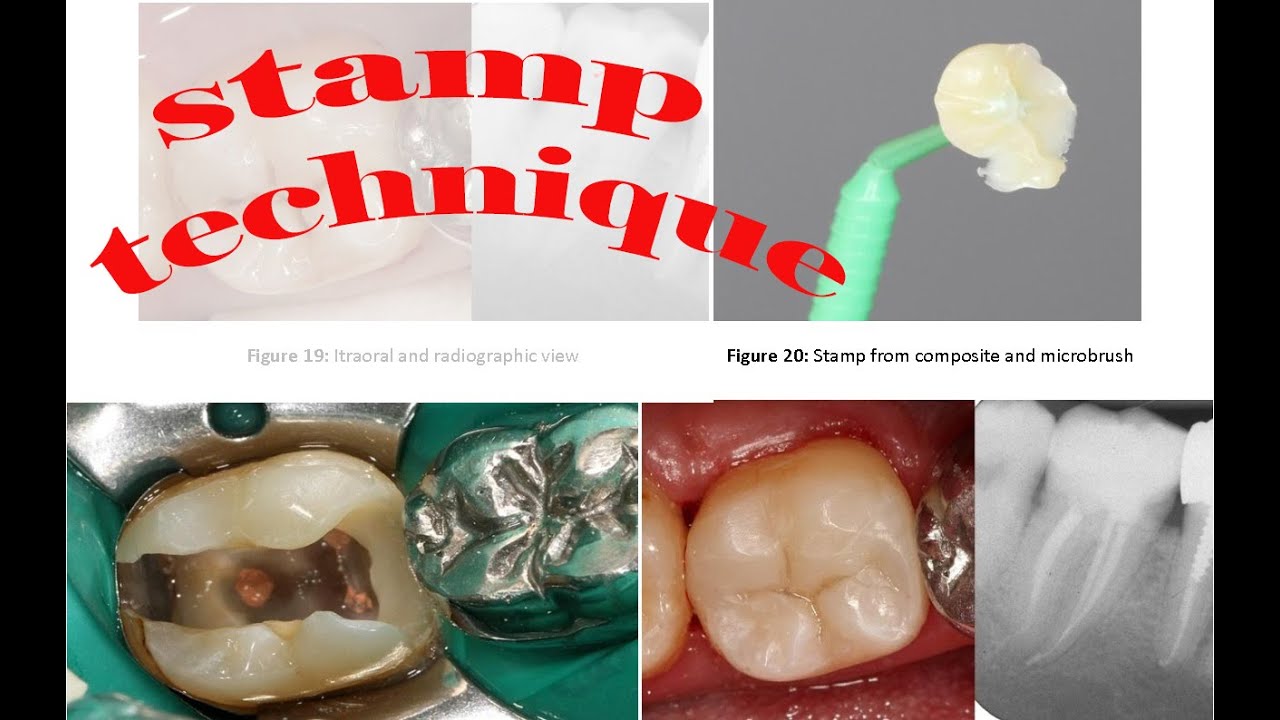 Occlusal stamp technique #micro_brush_stamp_technique - YouTube