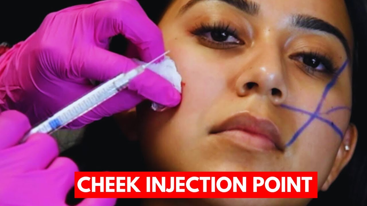 Cheek Filler Injection | Cheek Filler Injection Perfect Point # ...