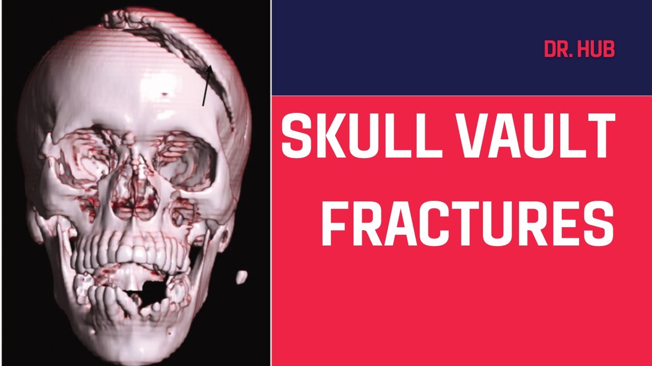 Types Of Skull Vault Fractures - YouTube
