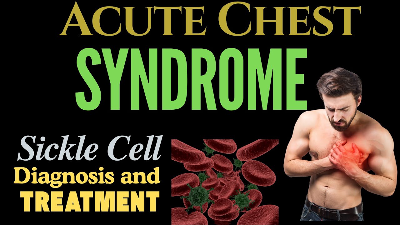 Understanding Acute Chest Syndrome: A Sickle Cell Complication - YouTube