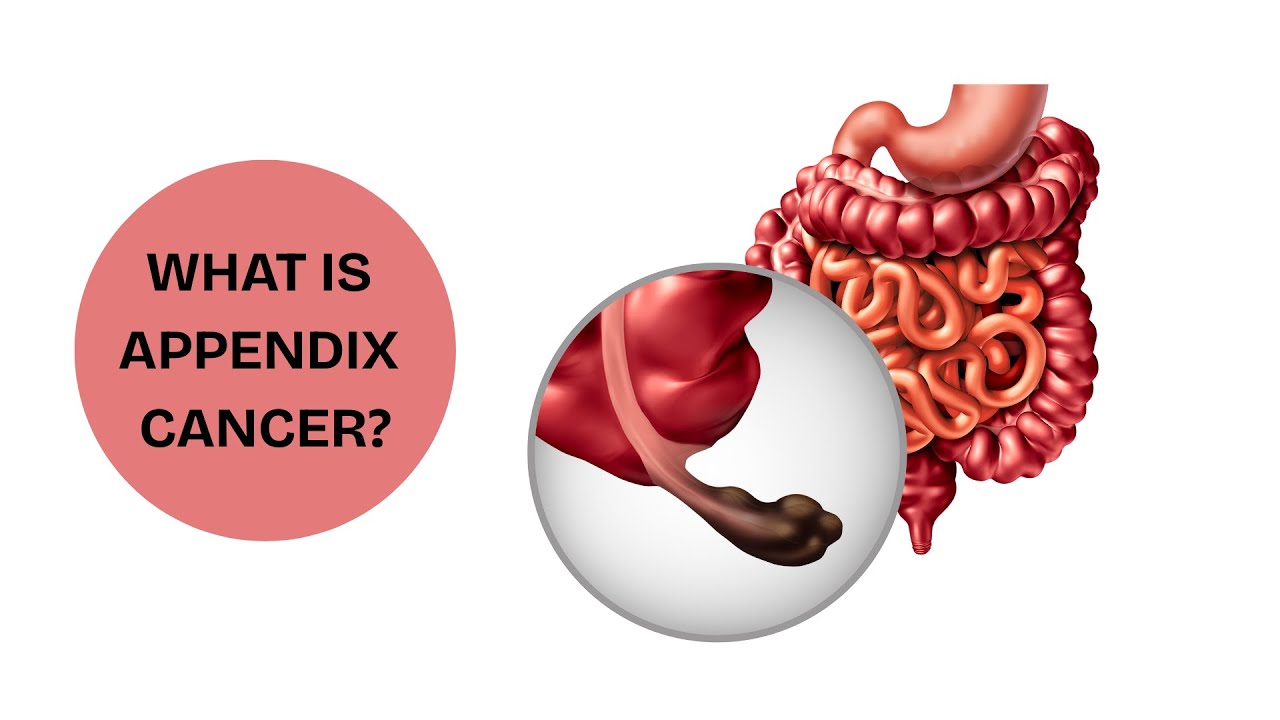 📹 What Is Appendix Cancer? Spot Cancer Early - YouTube