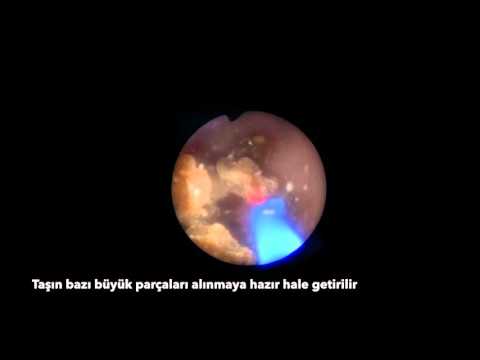 RIRS - Lazer ile 1.5 cm alt üreter taşı tedavisi