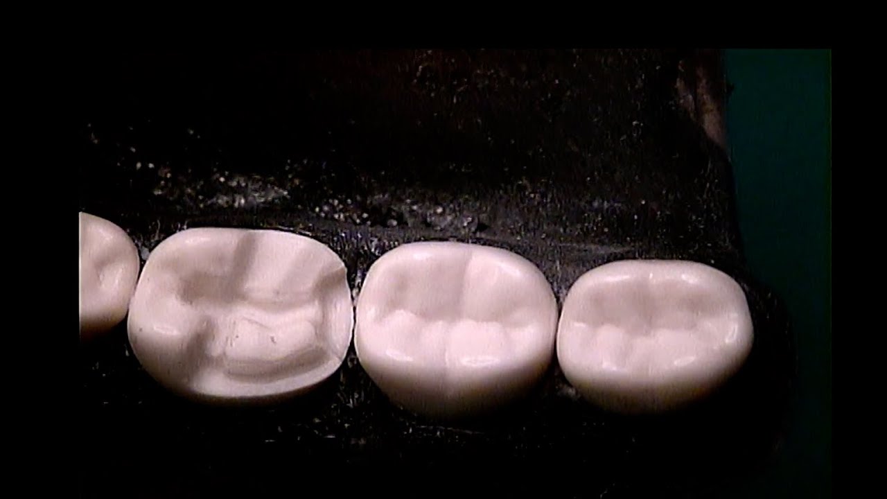 Ceramic Onlay Design 19 DOB - YouTube