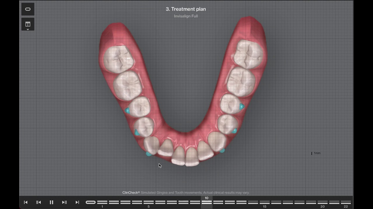 Dr Jignesh Kothari- clincheck 2: crowding in upper and lower teeth ...