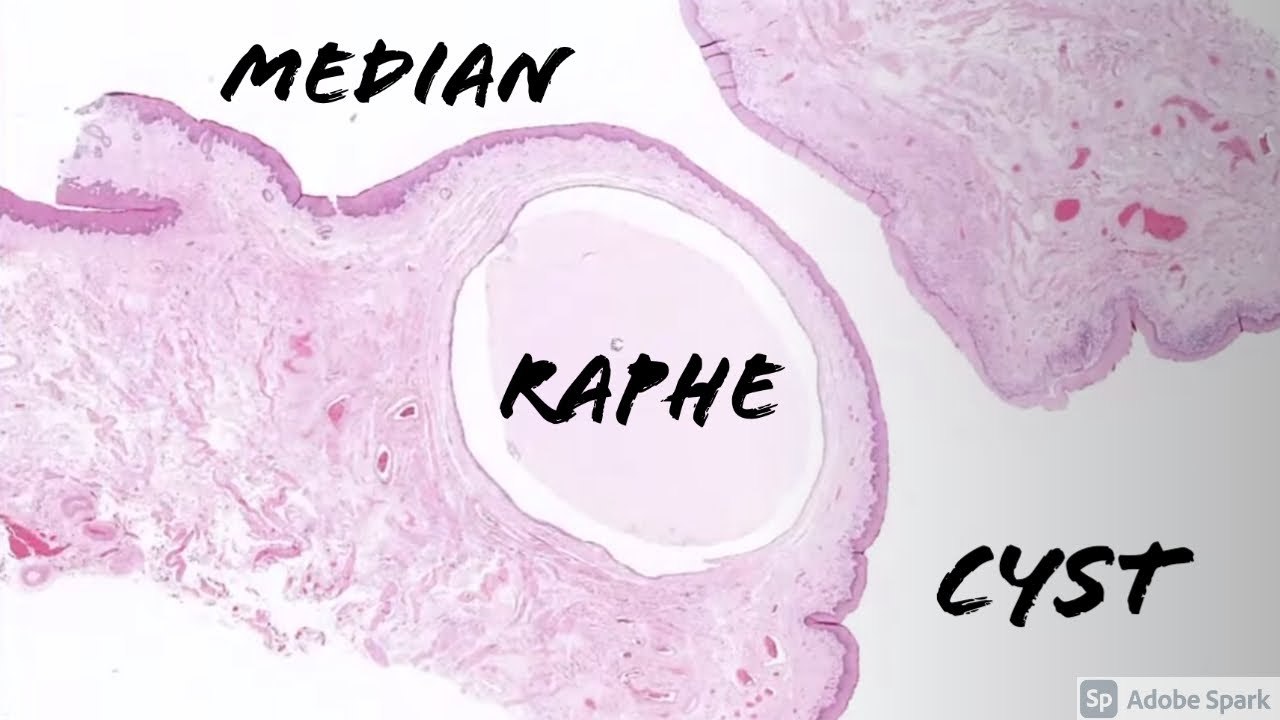 Median Raphe Cyst: 5-Minute Pathology Pearls - YouTube