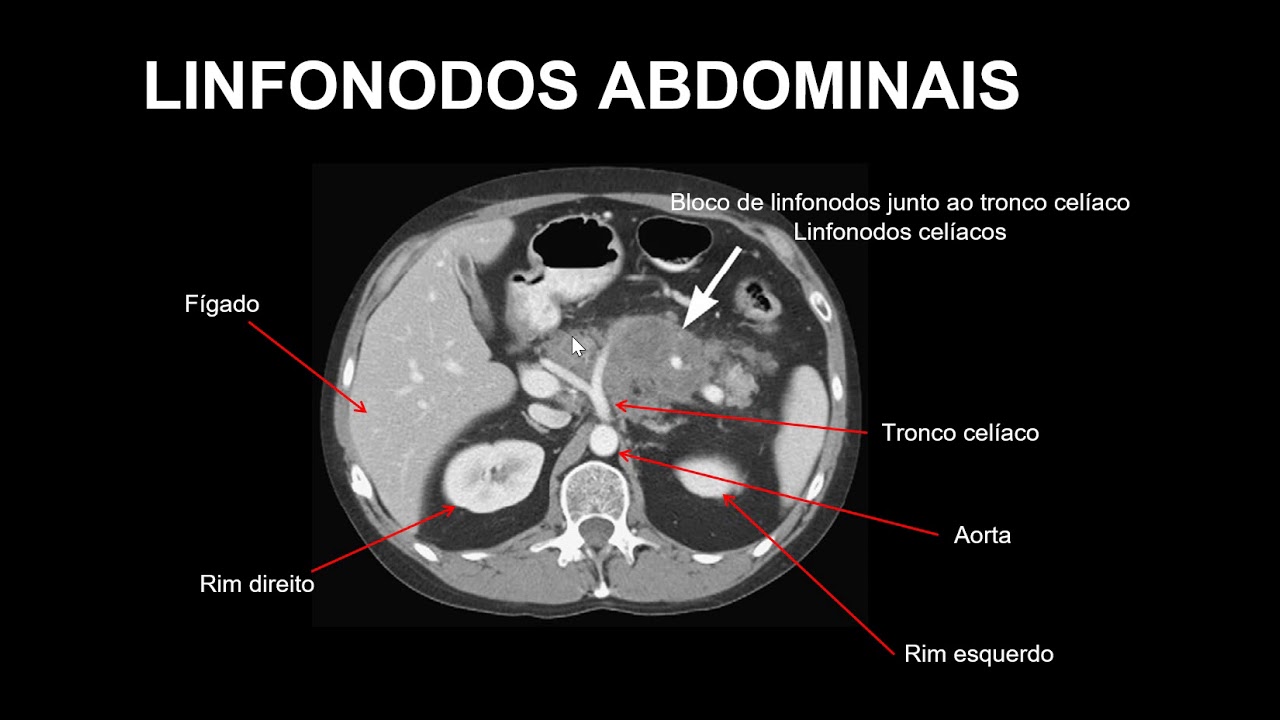 IMAGINOLOGIA LINFONODOS ABDOME SUPERIOR E PELVE - YouTube