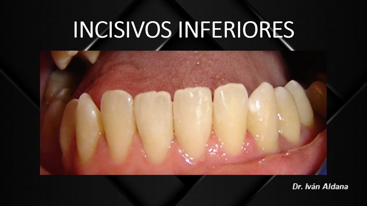 ANATOMÍA DENTARIA - Unidad 2.2: INCISIVOS INFERIORES (parte 1) - DR ...