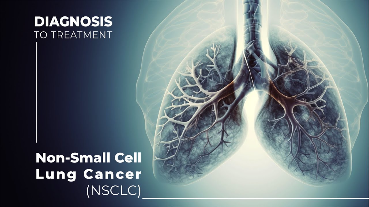 What Are the Options: Lung Cancer & Non-Small Cell Lung Cancer (NSCLC ...